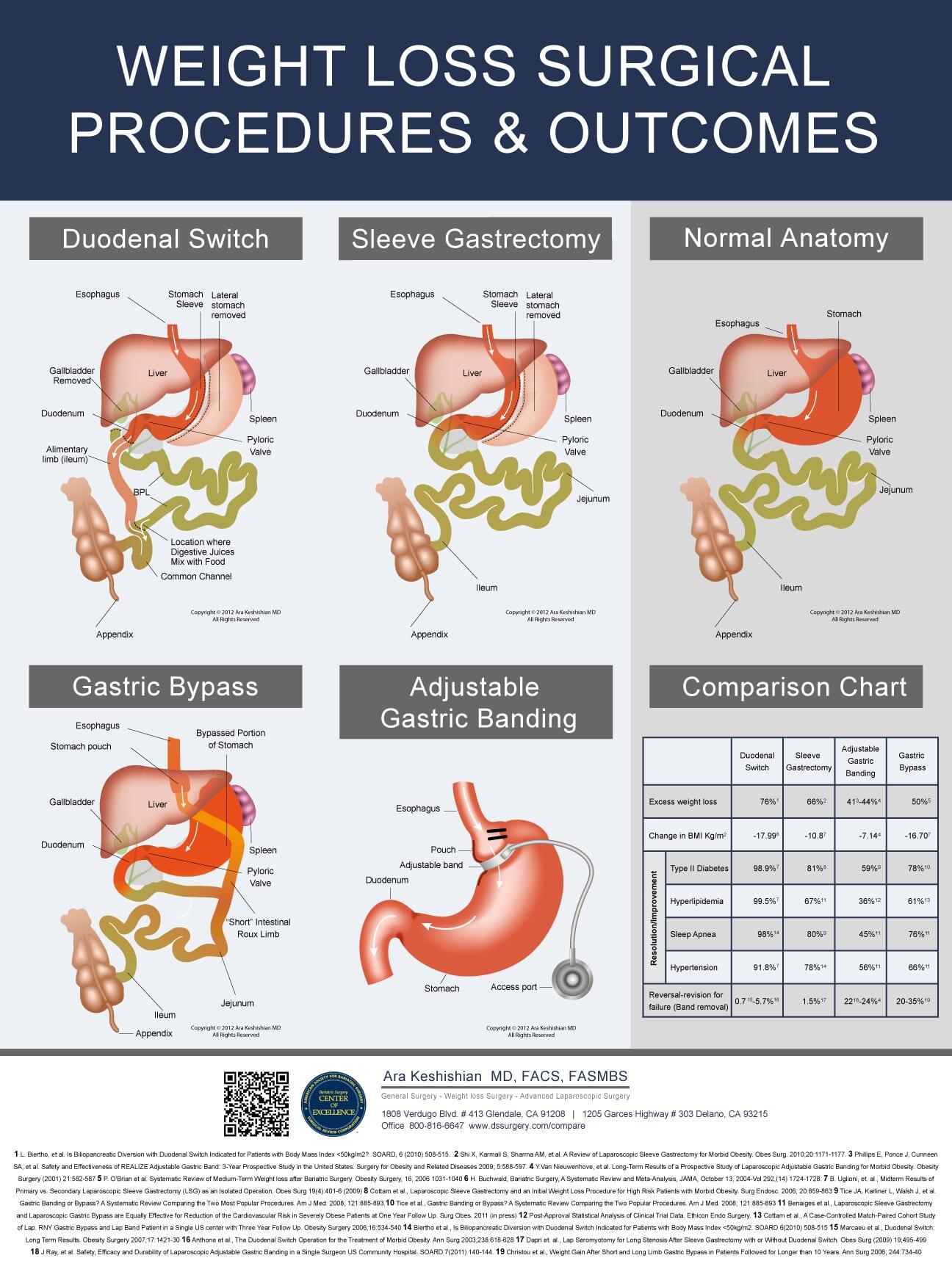 Weight Loss Surgery Poster DSSurgery Weight Loss Surgery Poster DSSurgery