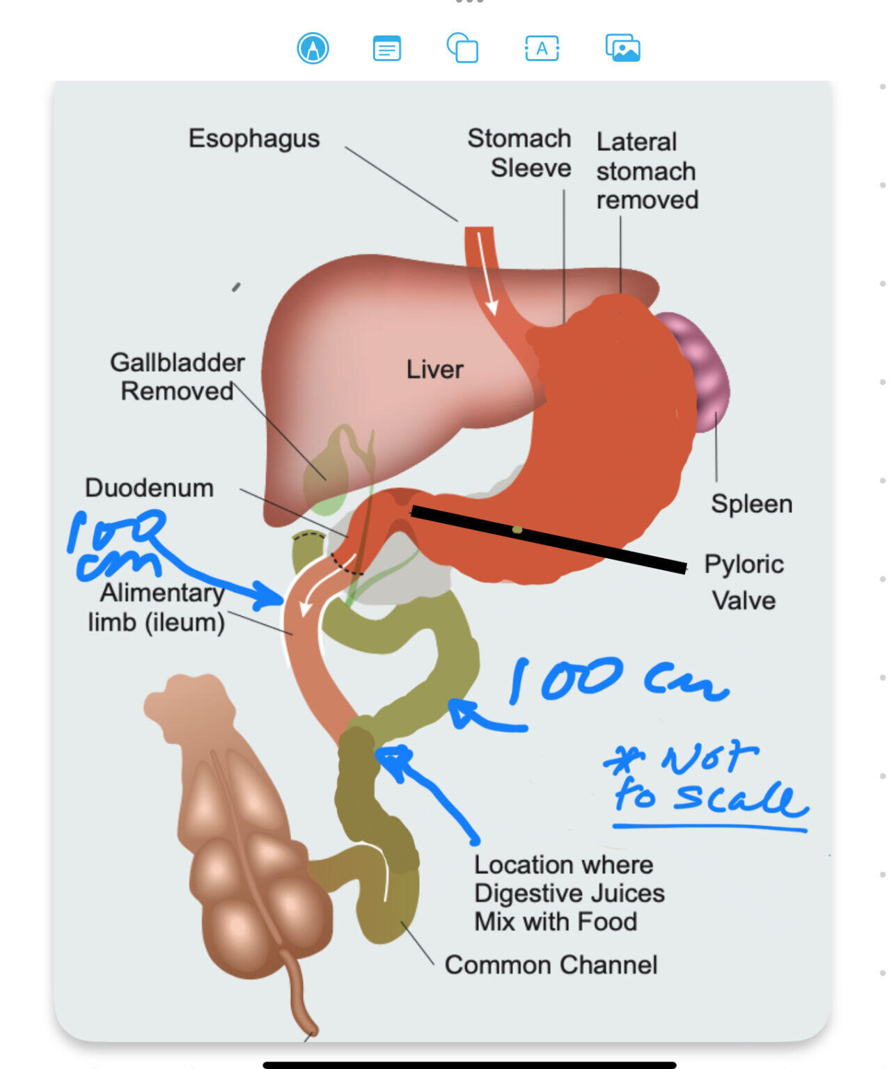 Bile Reflux Gastritis - DSSurgery