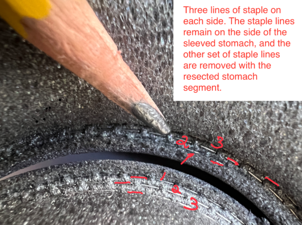 Staples Used in Gastrointestinal Surgery - DSSurgery