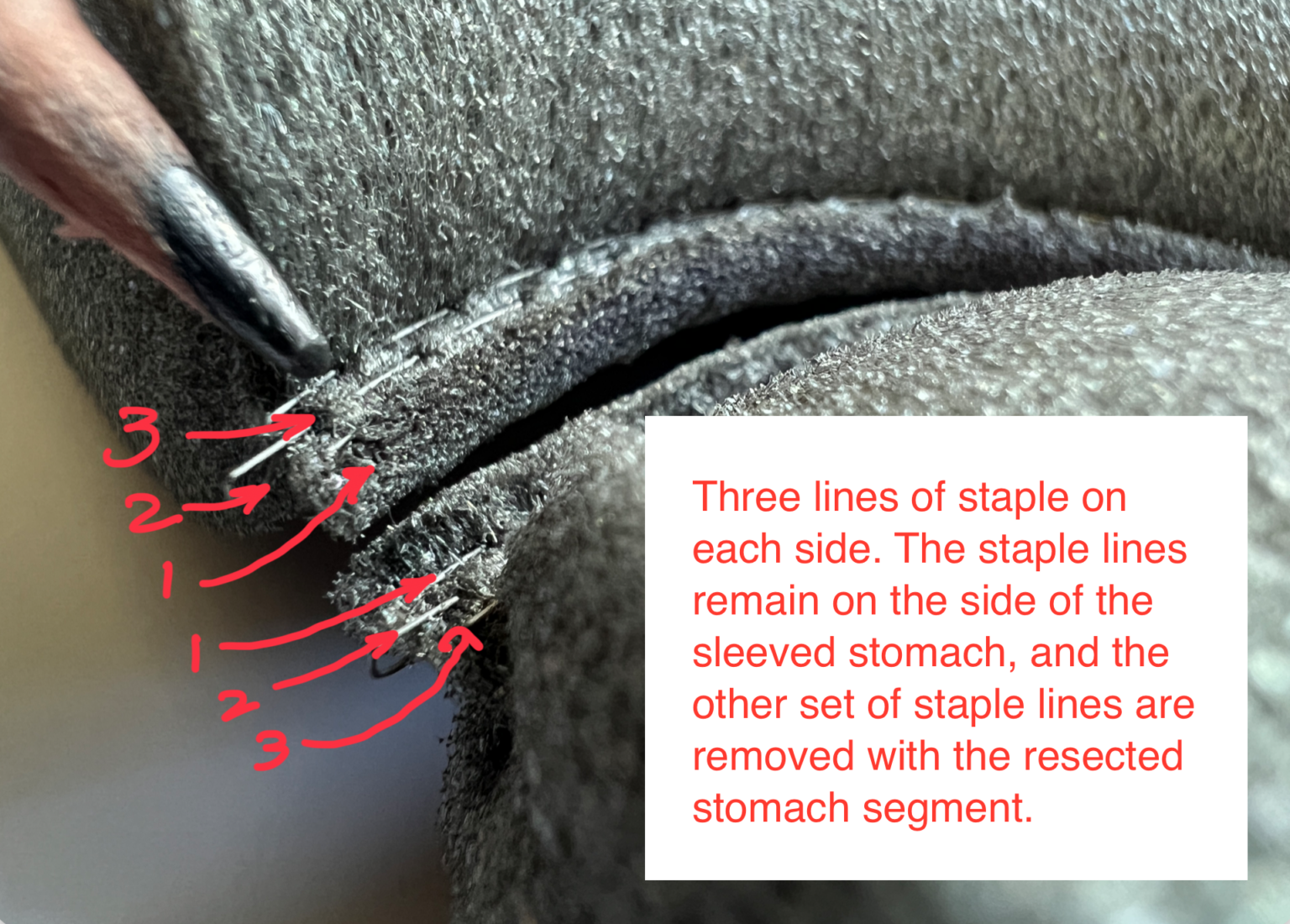 Staples Used in Gastrointestinal Surgery - DSSurgery