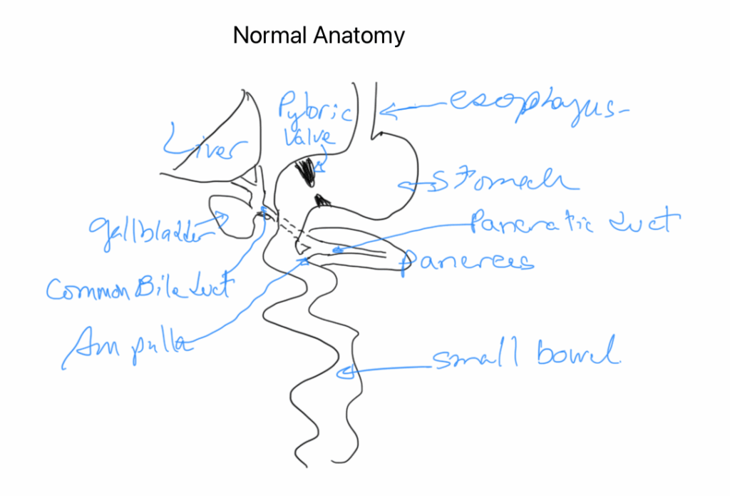 Bile Reflux Gastritis and Cholecystectomy - DSSurgery