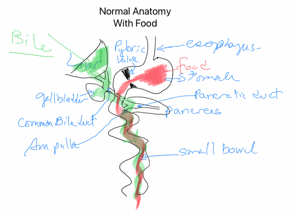 Bile Reflux Gastritis and Cholecystectomy - DSSurgery